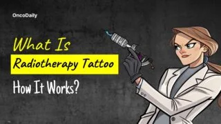 What Is Radiotherapy Tattoo and How It Works? - OncoDaily