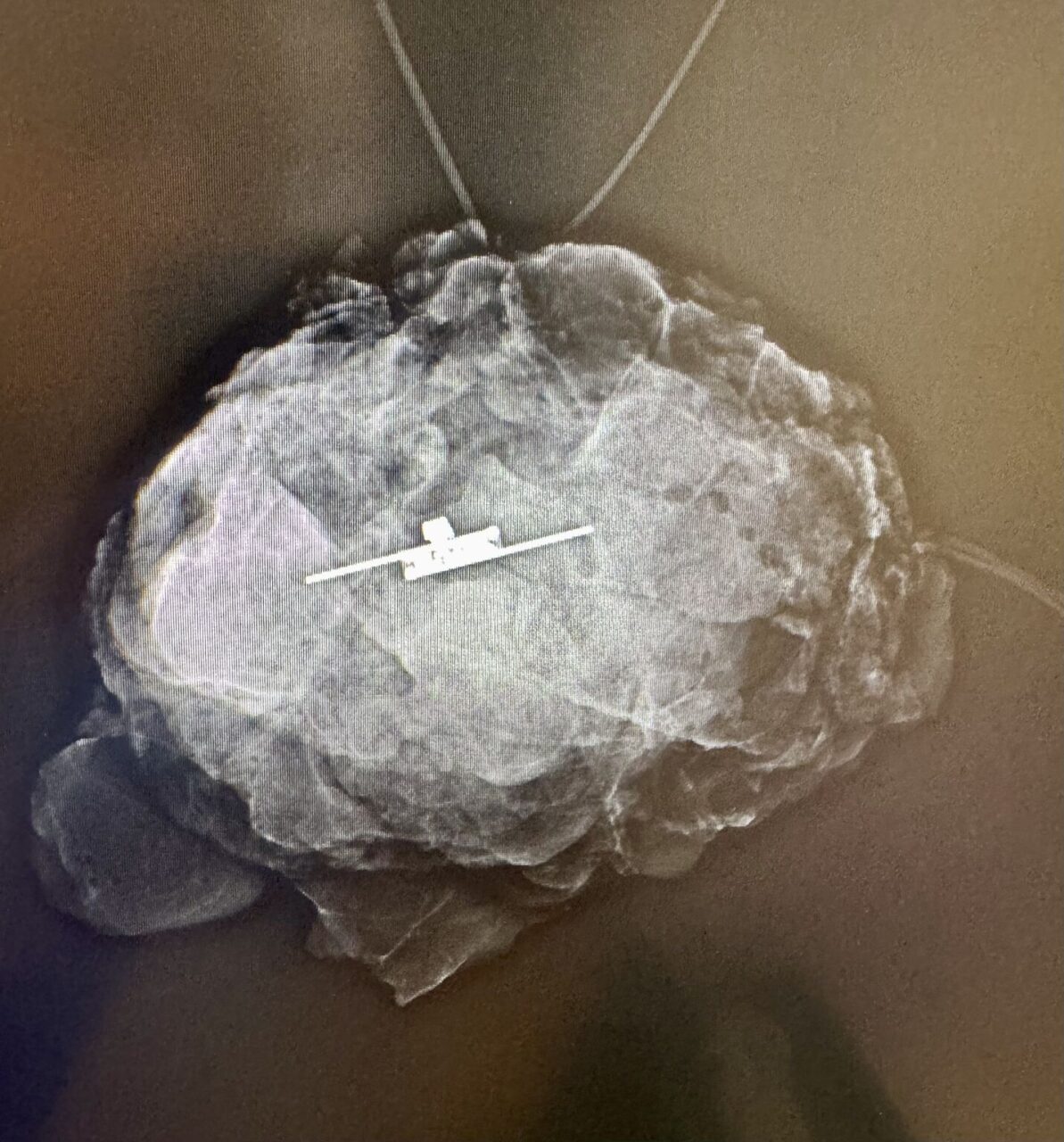 Kefah Mokbel: The Remarkable Progress in Breast Localisation and ...